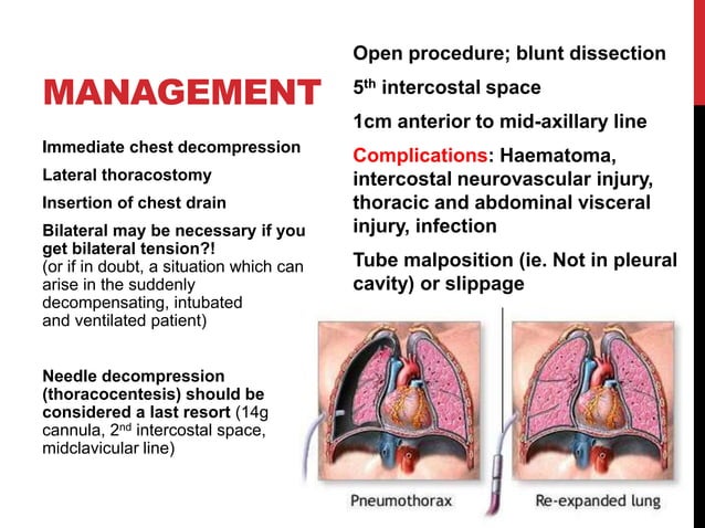 Thoracic trauma presentation | PPTX