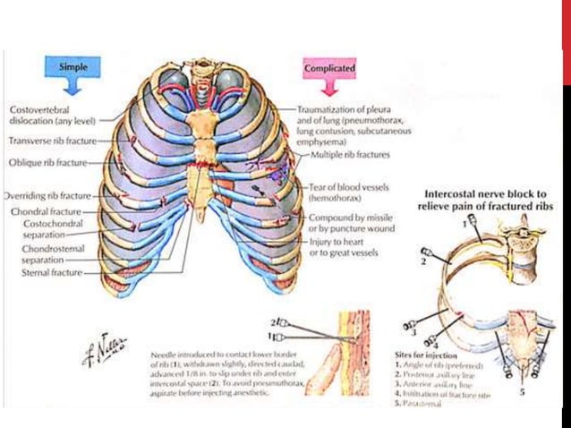 Thoracic trauma presentation | PPTX