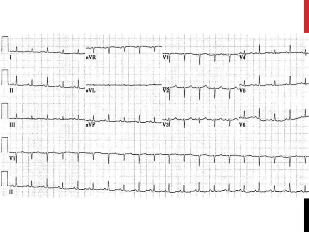 Thoracic trauma presentation | PPTX