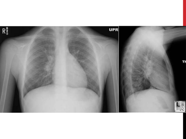 Thoracic trauma presentation | PPTX