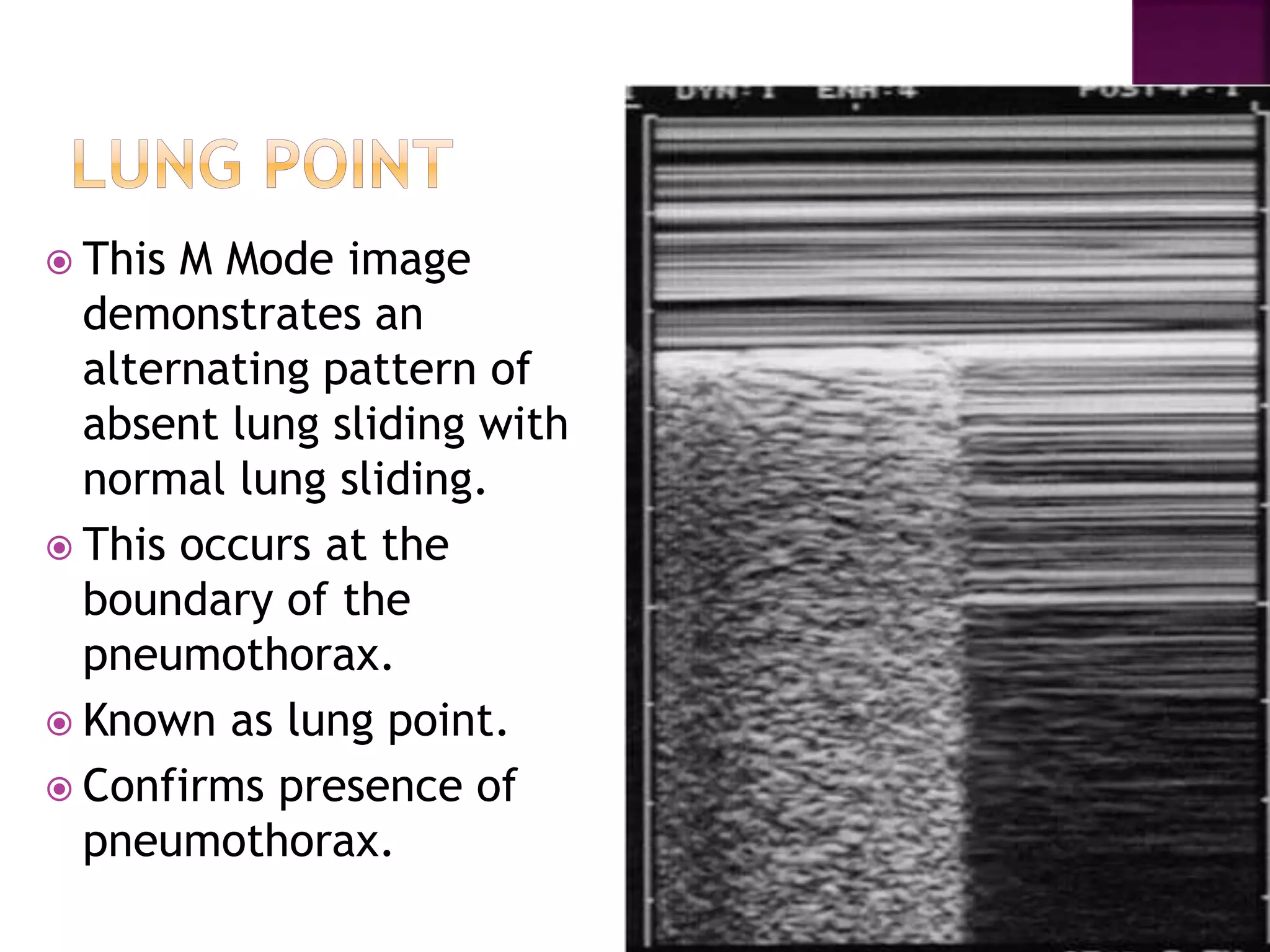 Thoracic ultrasonography ULTIMATE | PPTX