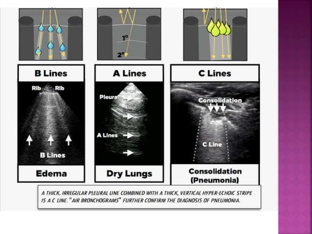 Thoracic ultrasonography ULTIMATE | PPTX | Lung and Respiratory Health ...