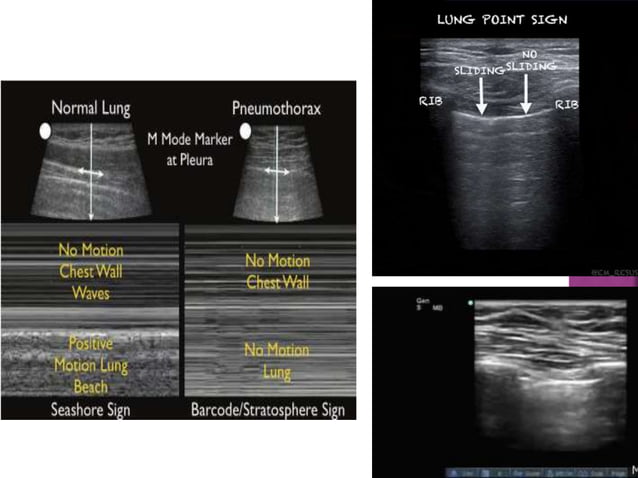 Thoracic ultrasonography ULTIMATE | PPTX | Lung and Respiratory Health ...