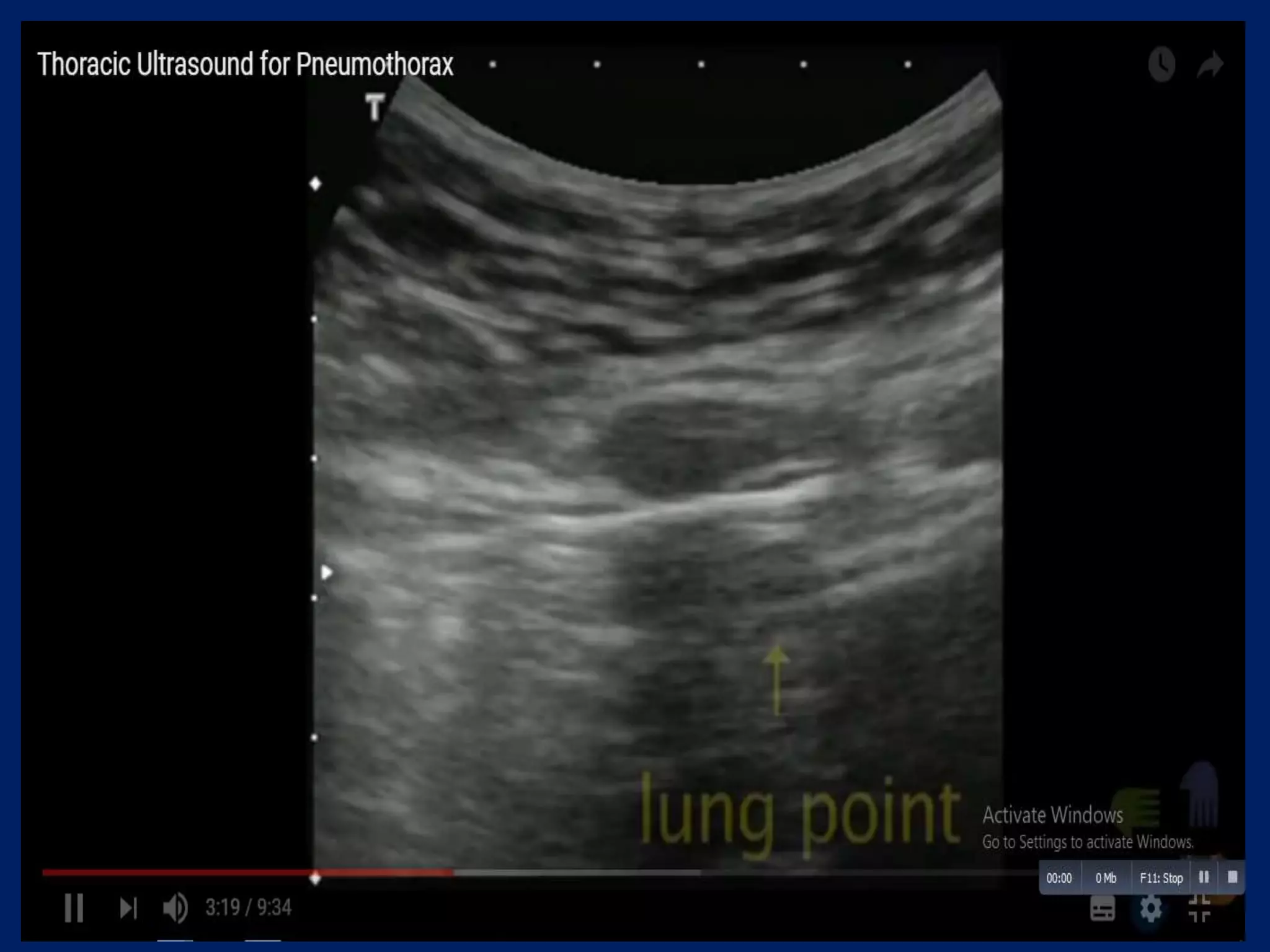 Thoracic ultrasound | PPTX