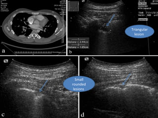 Thoracic Ultrasound For Diagnosing Pulmonary Embolism | PPT
