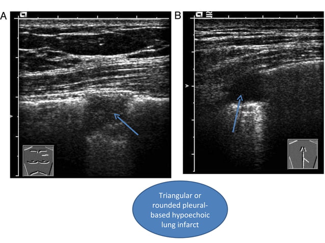 Thoracic Ultrasound For Diagnosing Pulmonary Embolism