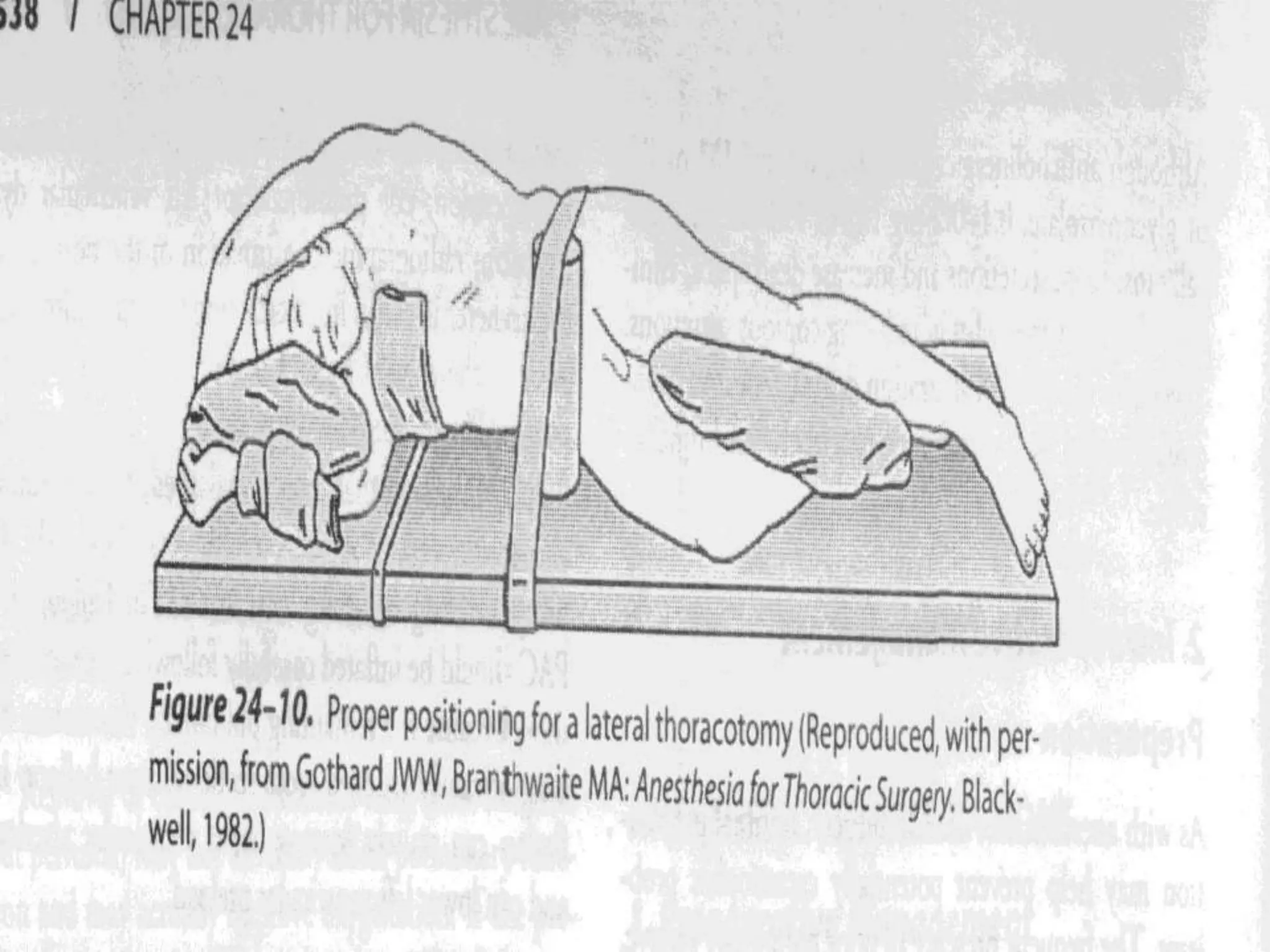 Thoracic surgery anesthesia | PPTX