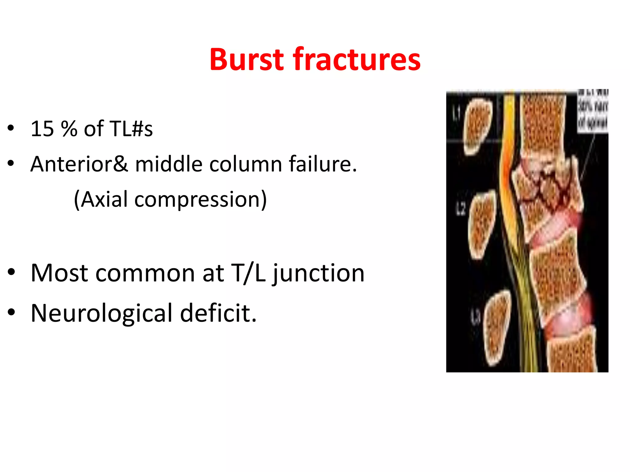 Thoraco lumbar fractures | PPTX