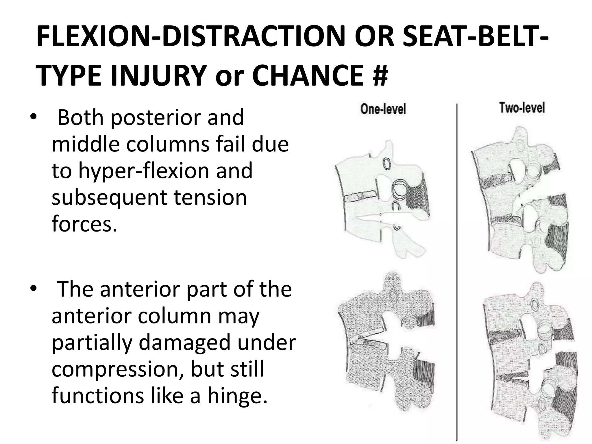 Thoraco lumbar fractures of spine | PPTX