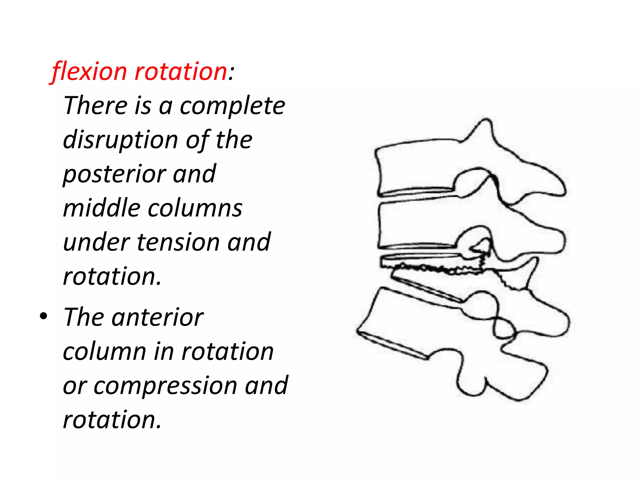 Thoraco lumbar fractures of spine | PPTX