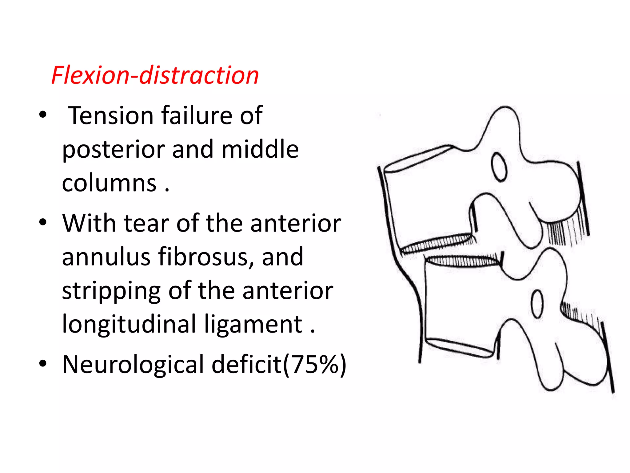 Thoraco lumbar fractures of spine | PPTX