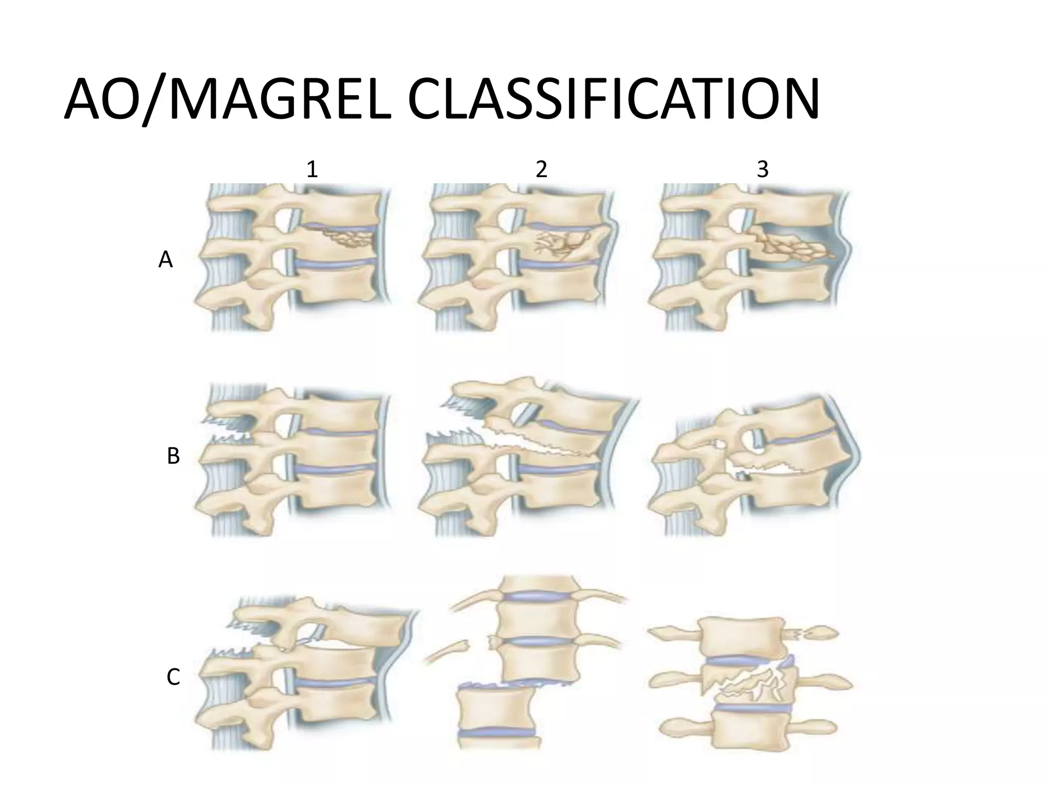 Thoraco lumbar fractures of spine | PPTX