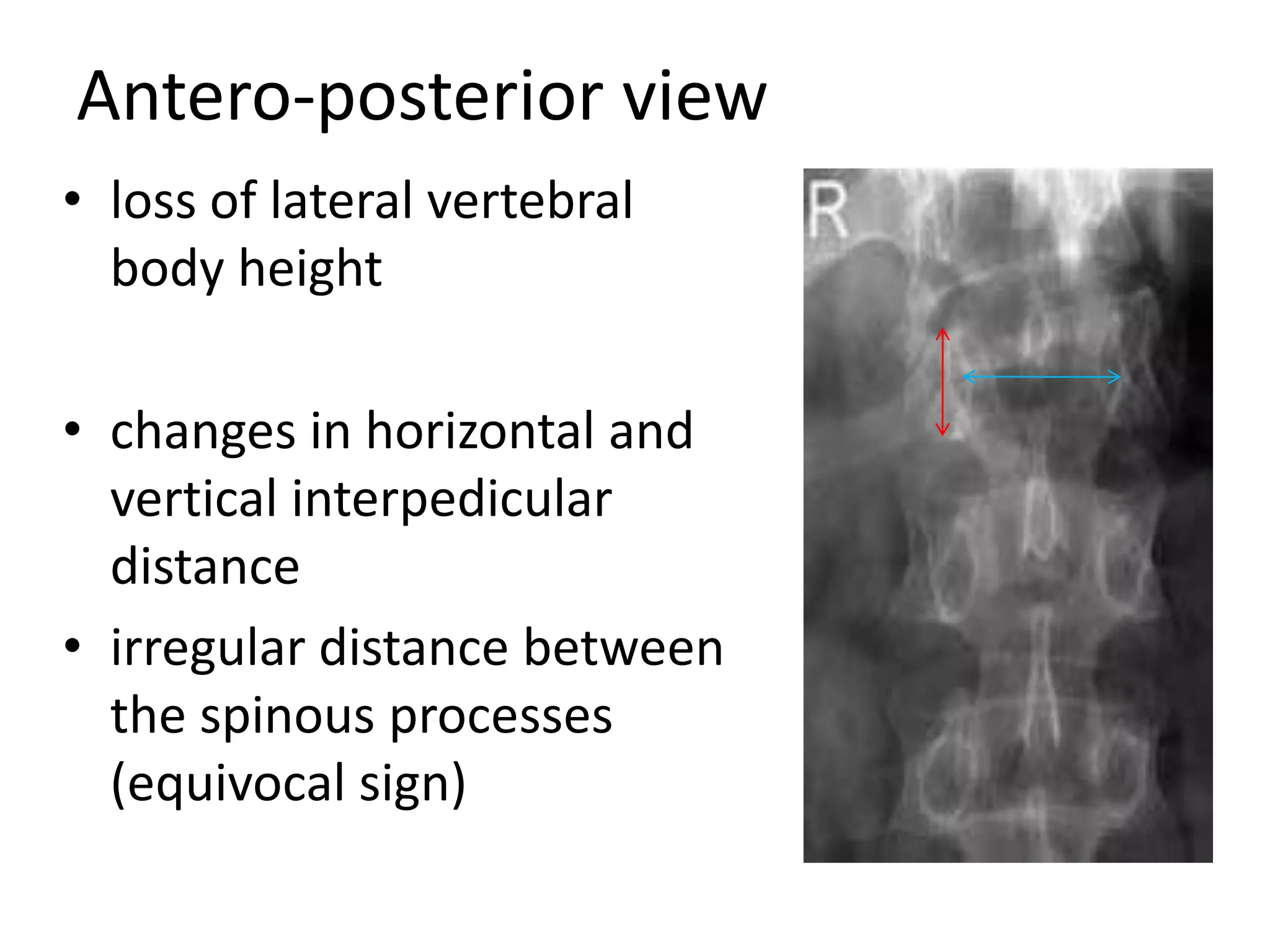 Thoraco lumbar fractures of spine | PPTX