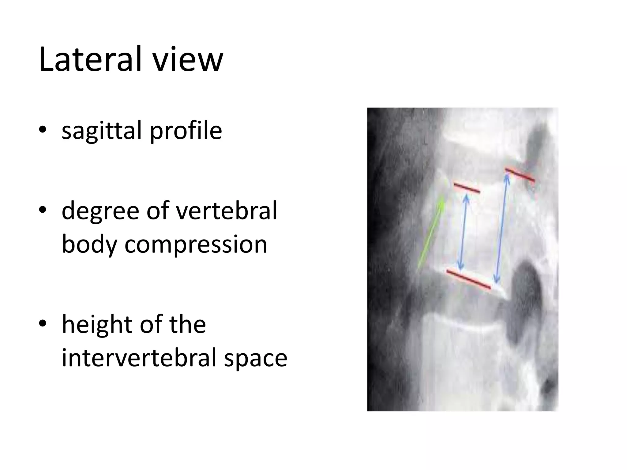 Thoraco lumbar fractures of spine | PPTX