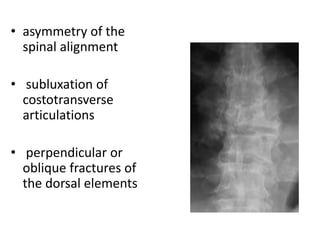 Thoraco lumbar fractures of spine | PPTX