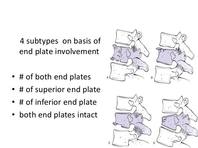 Thoraco lumbar fractures of spine