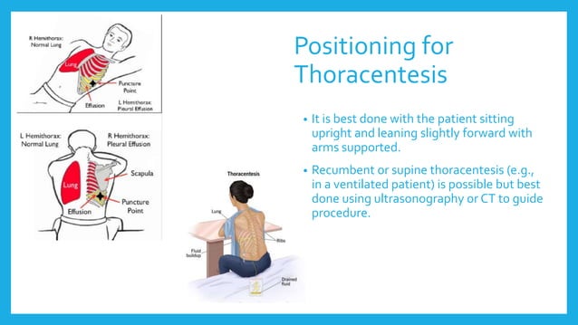Thoracocentesis or Thoracentesis or Chest Tube.pptx | Lung and ...