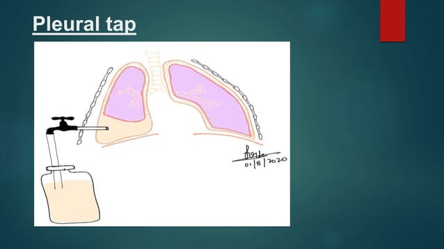 Thoracocentesis / pleural effusion | PPT