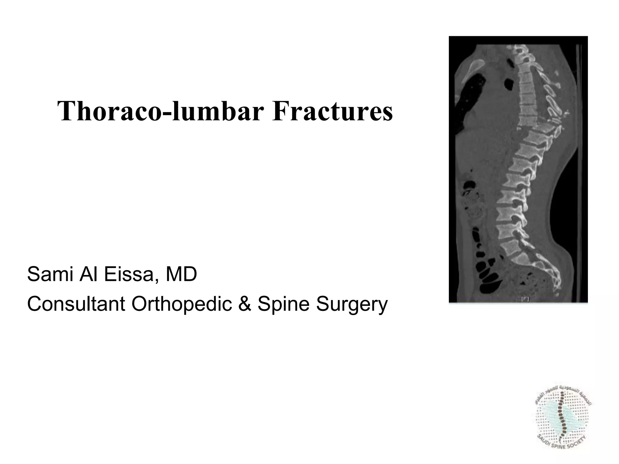 Thoracolumbar-spine-fracture-.ppt