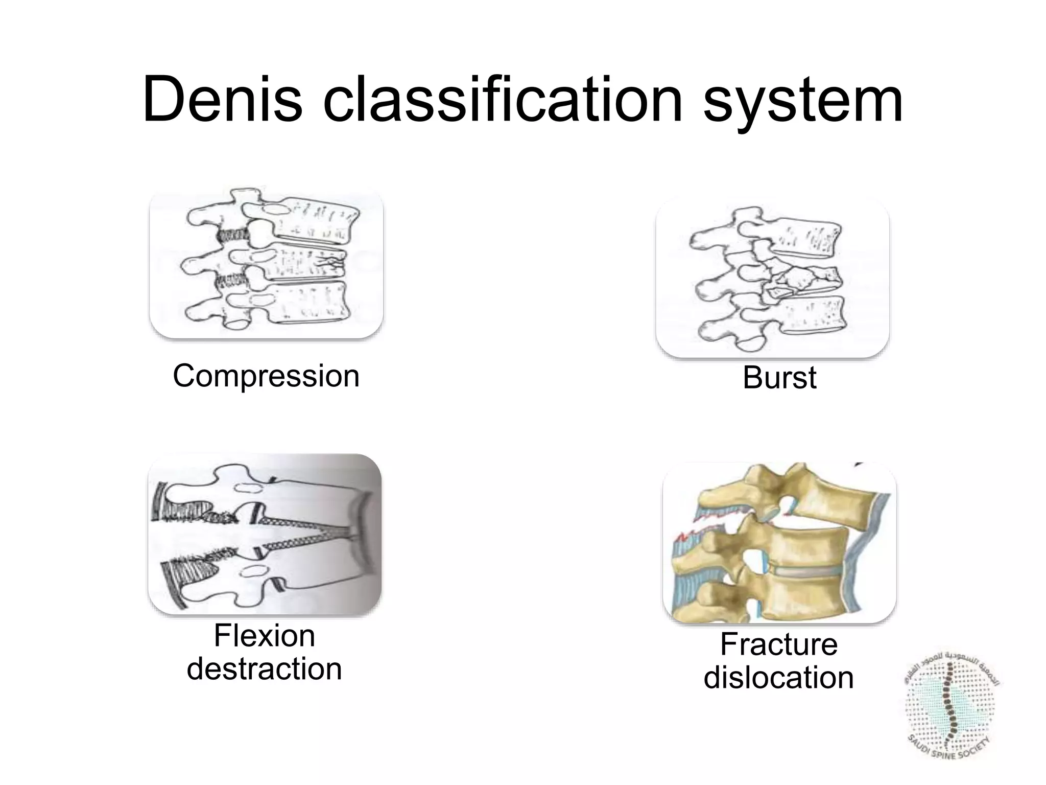 Thoracolumbar-spine-fracture-.ppt