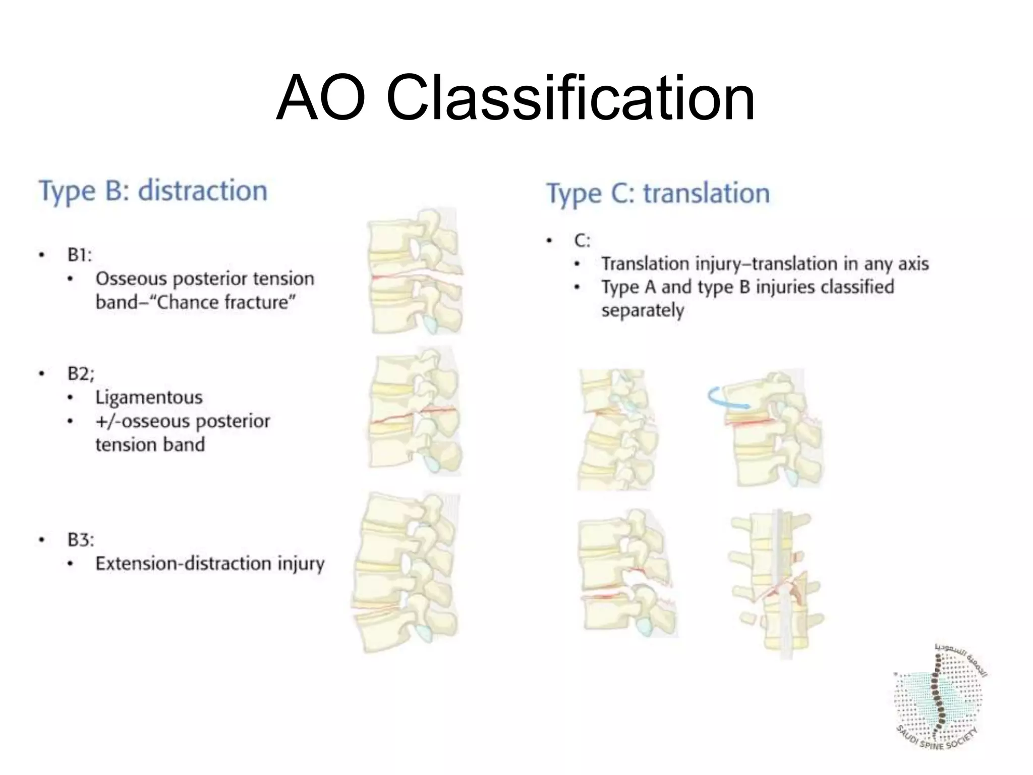 Thoracolumbar-spine-fracture-.ppt