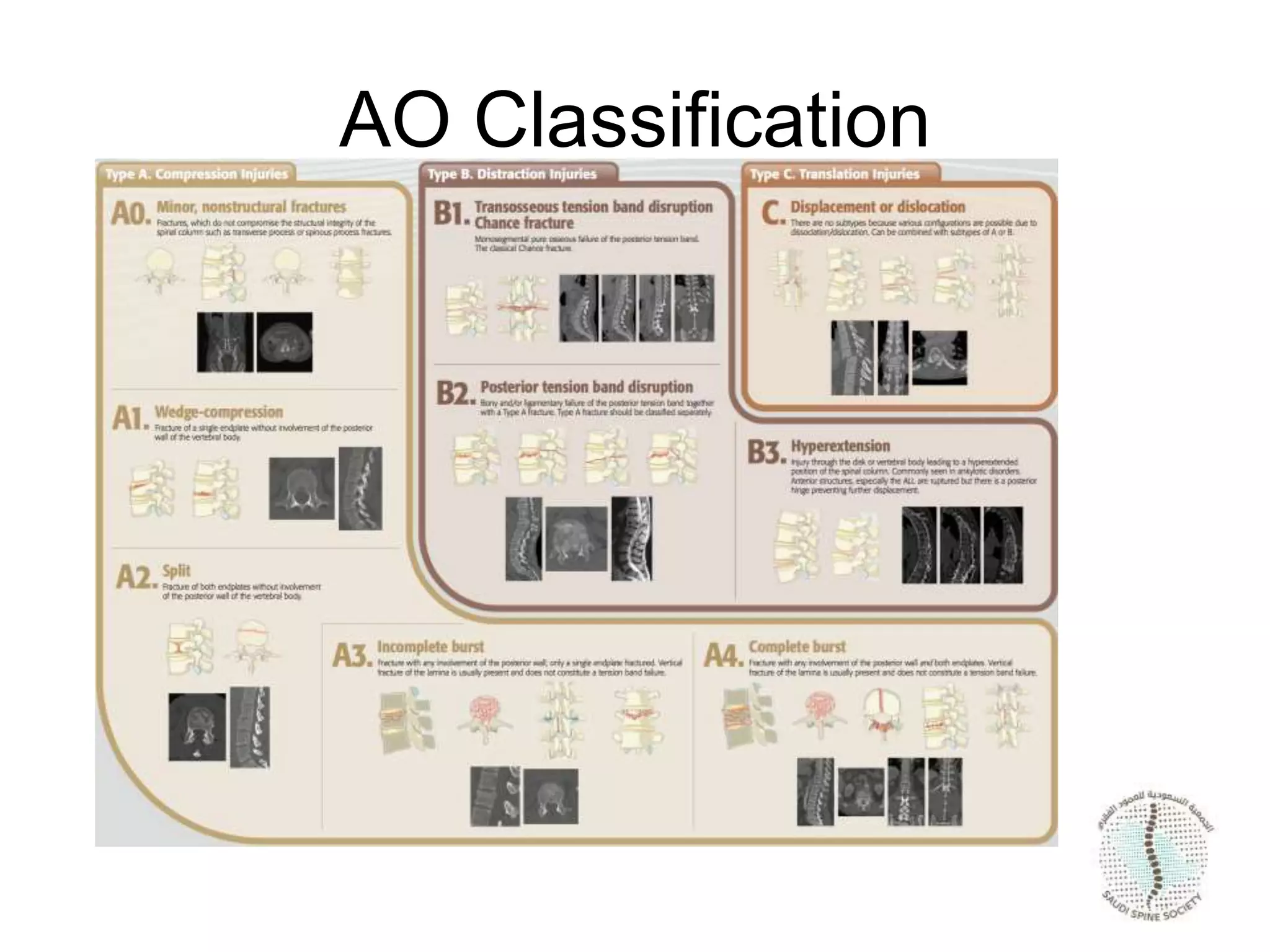 Thoracolumbar-spine-fracture-.ppt