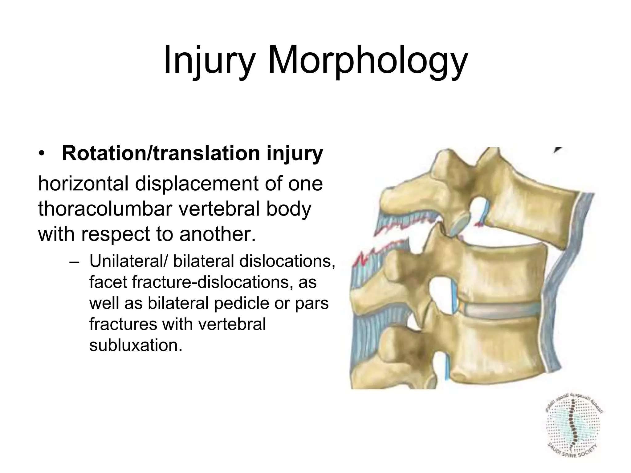 Thoracolumbar-spine-fracture-.ppt