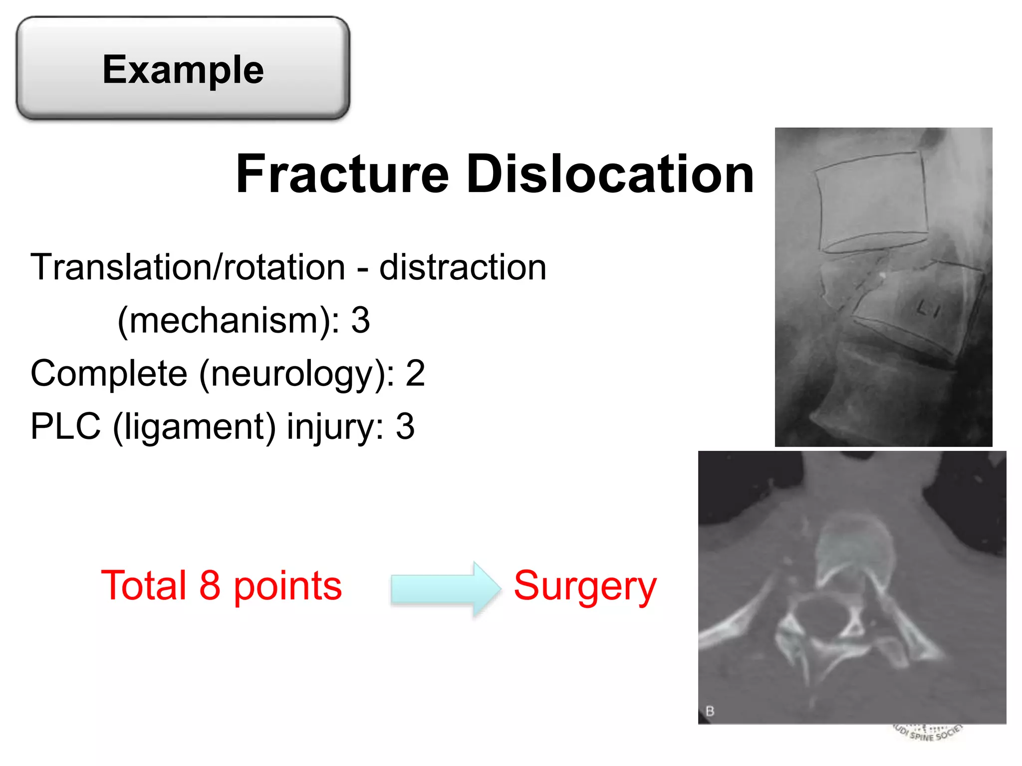 Thoracolumbar-spine-fracture-.ppt