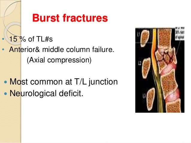 Thoracolumbar fracture cme