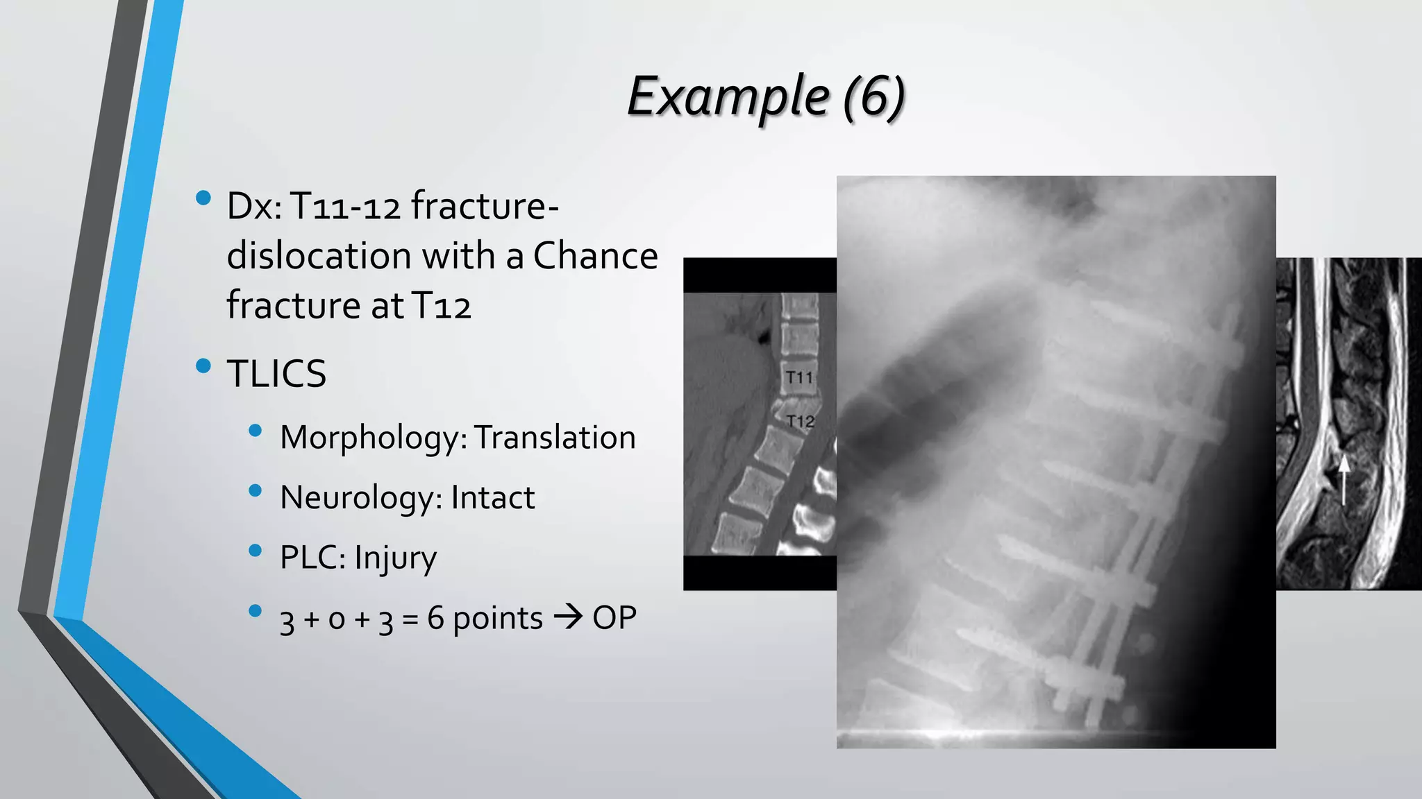 Thoracolumbar fractures classification | PPTX