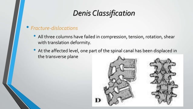 Thoracolumbar fractures classification | PPTX