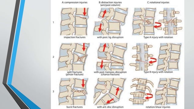 Thoracolumbar fractures classification | PPTX