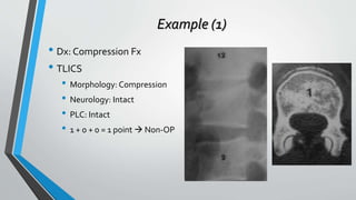 Thoracolumbar fractures classification | PPTX