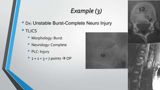 Thoracolumbar fractures classification | PPTX