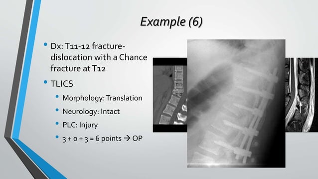Thoracolumbar fractures classification | PPTX