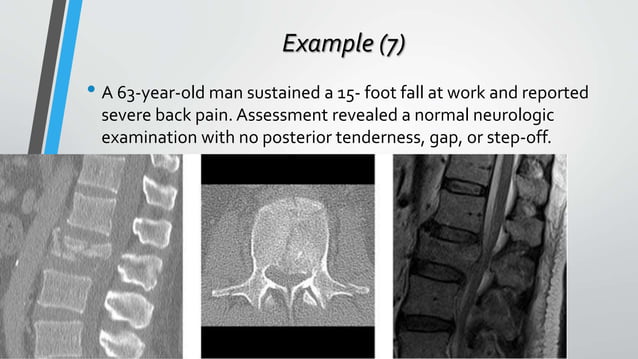 Thoracolumbar fractures classification | PPTX