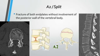 Thoracolumbar fractures classification | PPTX