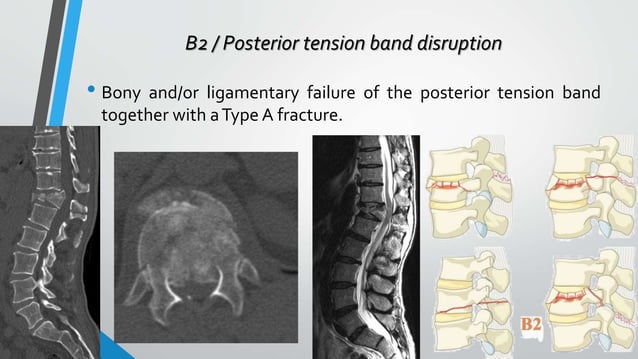 Thoracolumbar fractures classification | PPTX