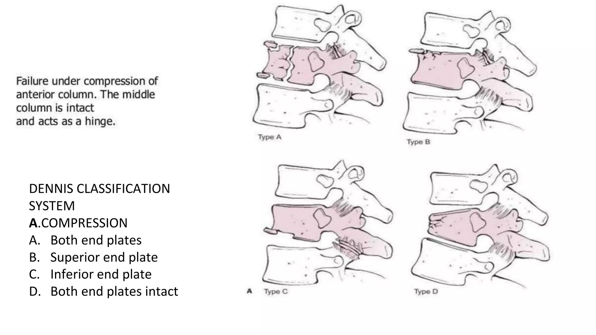 Thoracolumbar injuries | PPTX