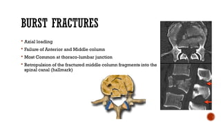 Thoracolumbar injuries and fractures…….. | PPTX