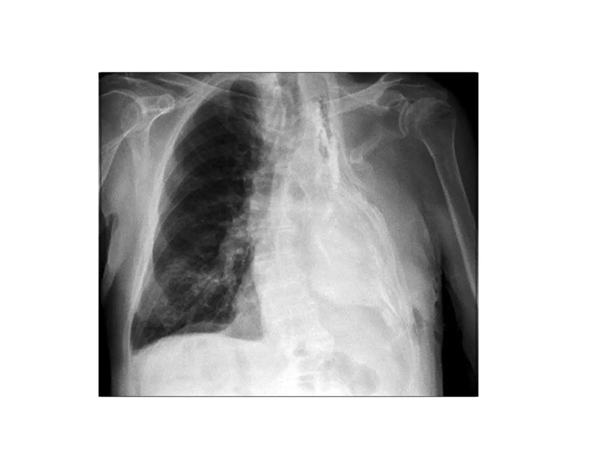 Thoracoplasty. | PPTX