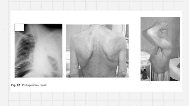 THORACOPLASTY (Taopa, Jenny G.)_20240911_143410_0000.pdf | Death ...