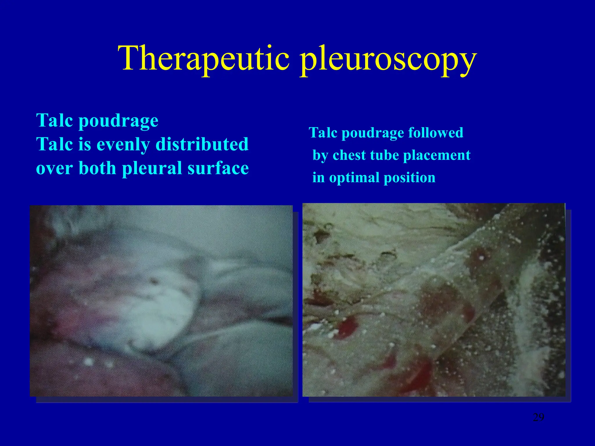 Medical Thoracoscopy | Jindal Chest Clinic | PPT
