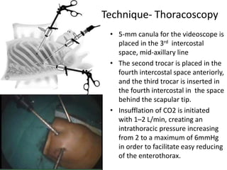 Thoracoscopy vs laparoscopy technical feasibility and complications in ...