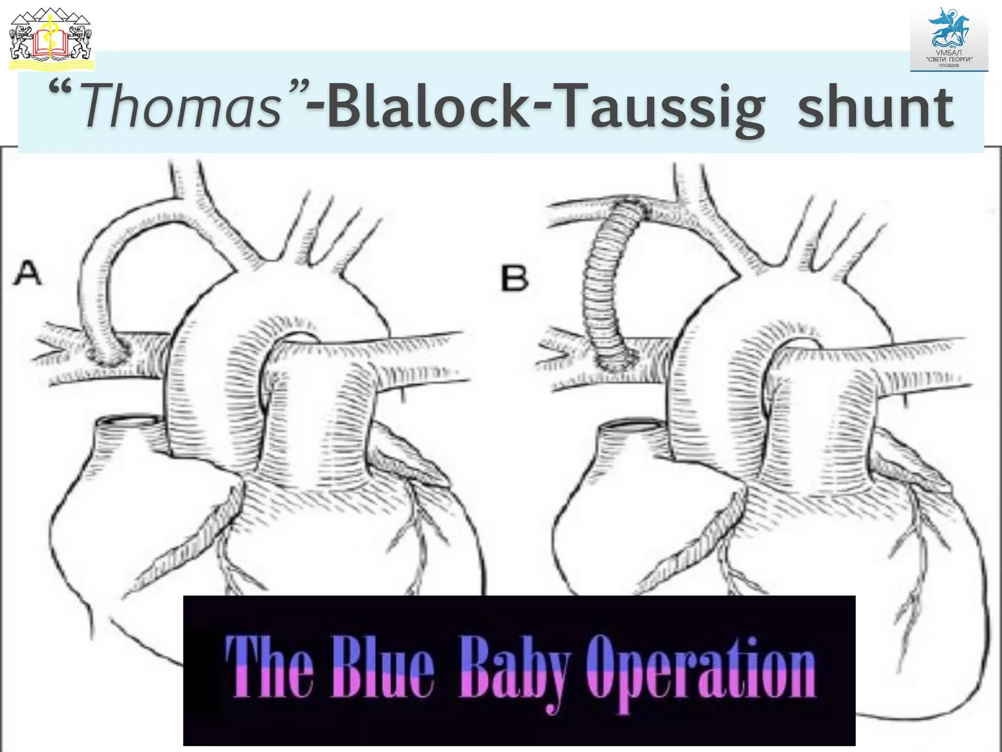 Thoracotomies/Торакотомии (БГ) | PPT