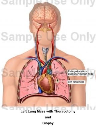 Thoracotomy | PPT