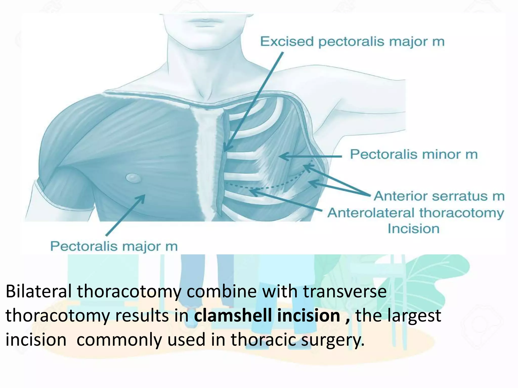 Thoracotomy | PPTX