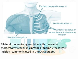 Thoracotomy | PPTX