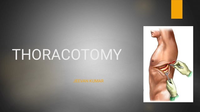 THORACOTOMY..............................pdf