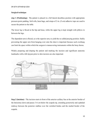 THORACOTOMY . SURGICAL PERSPECTIVES VOL 1 | PDF